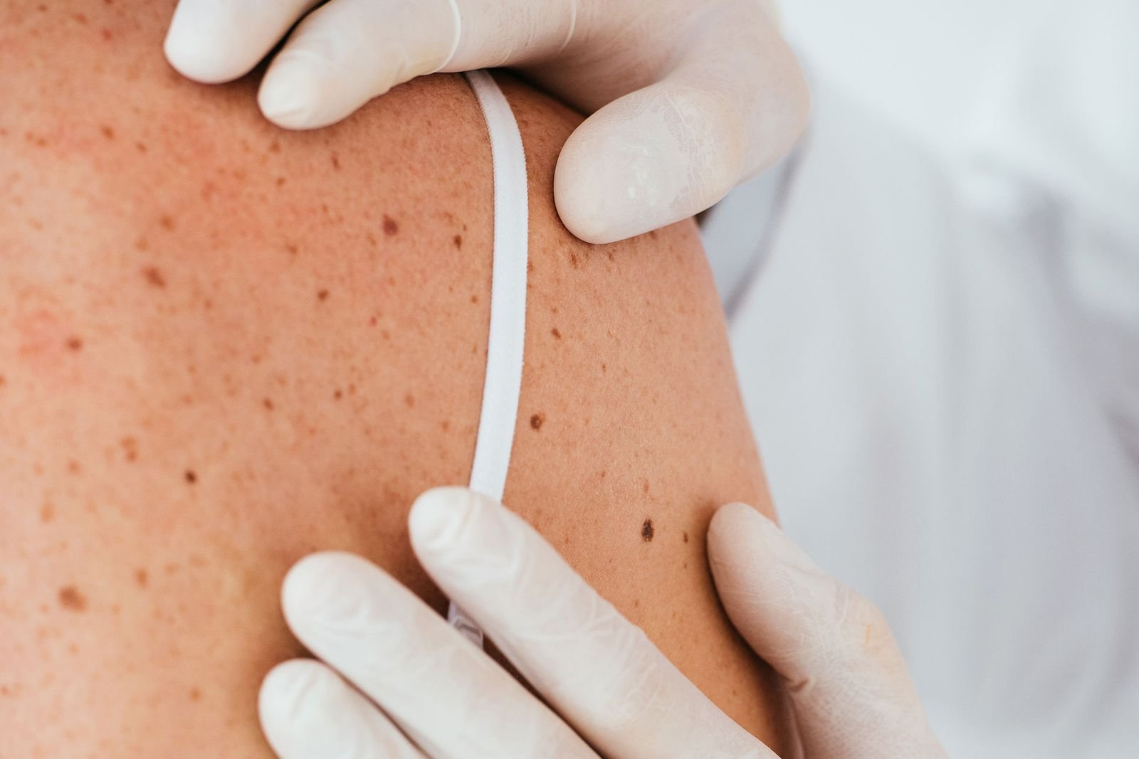 Map My Mole | Anele Health and Beauty